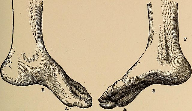 Best Shoes for Posterior Tibial Tendonitis [PTTD] - Top Shoes Reviews